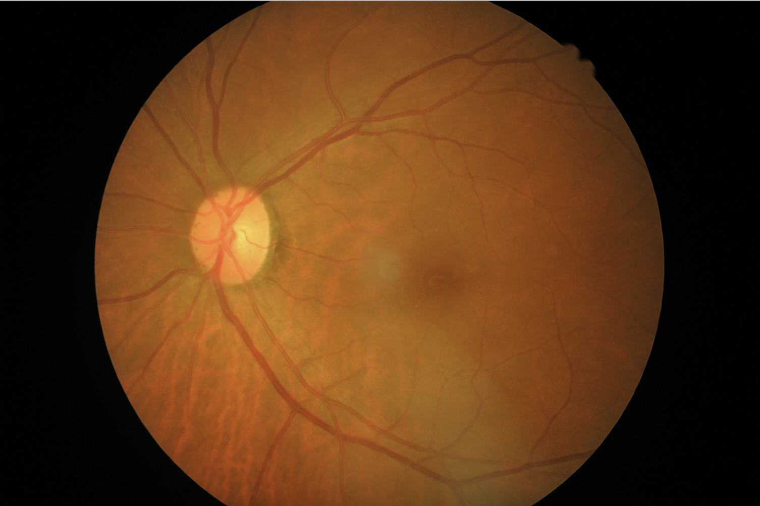 SGEM#245: Flash-errrs (POCUS for Retinal Detachments) | The Skeptics ...